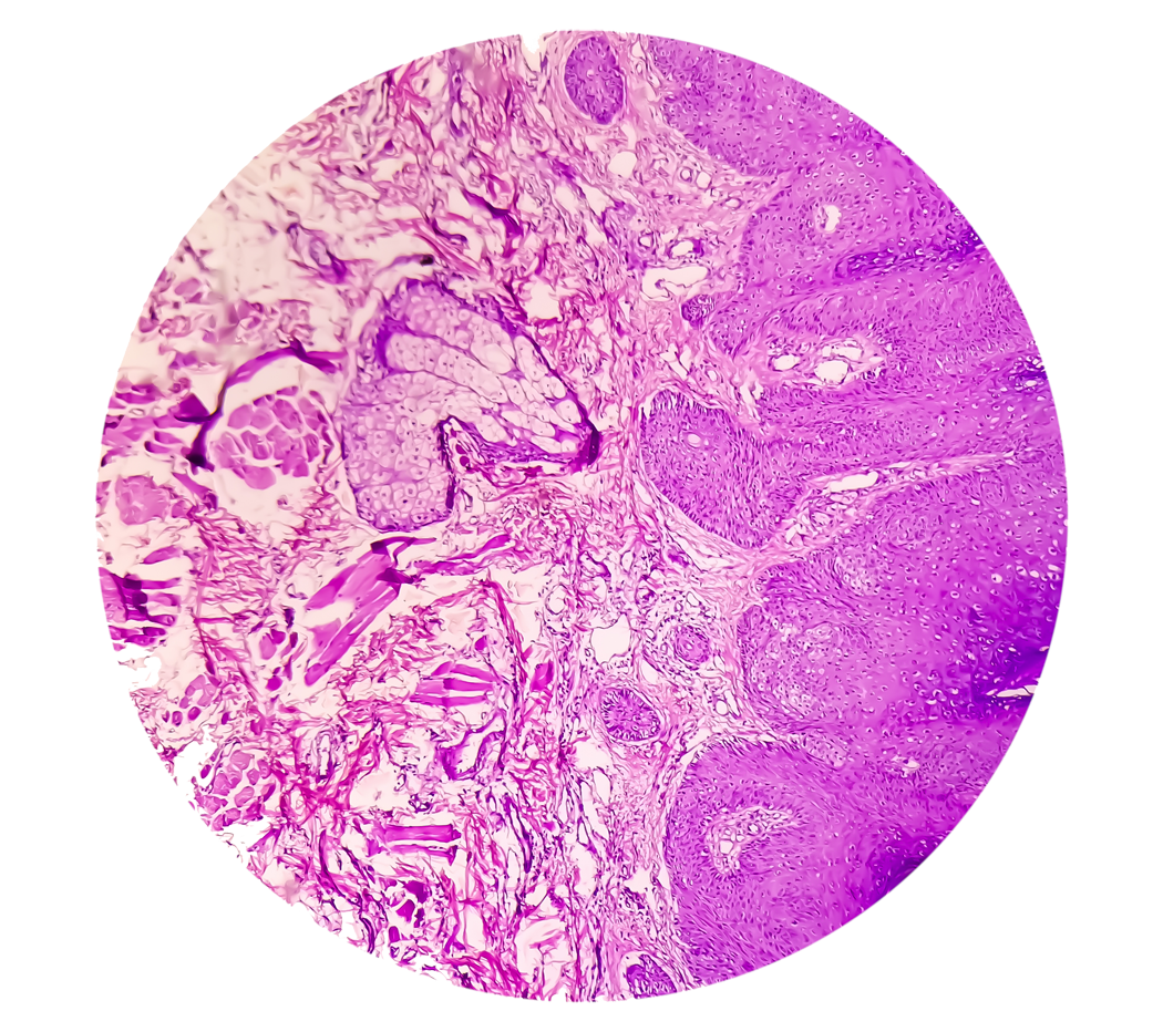 Verruche e Condilomi | HPV papilloma virus | Dermo Micro Chirurgia Laser