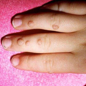 Trattamento Laser Verruche | volgari o comuni, piane, filiformi e plantari