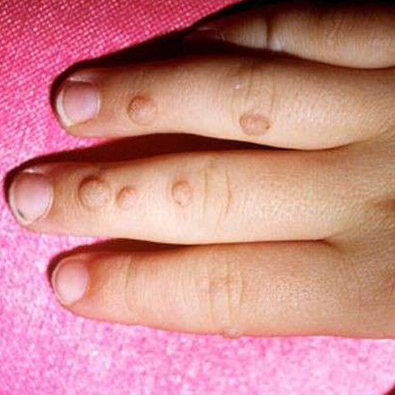 Trattamento Laser Verruche | volgari o comuni, piane, filiformi e plantari